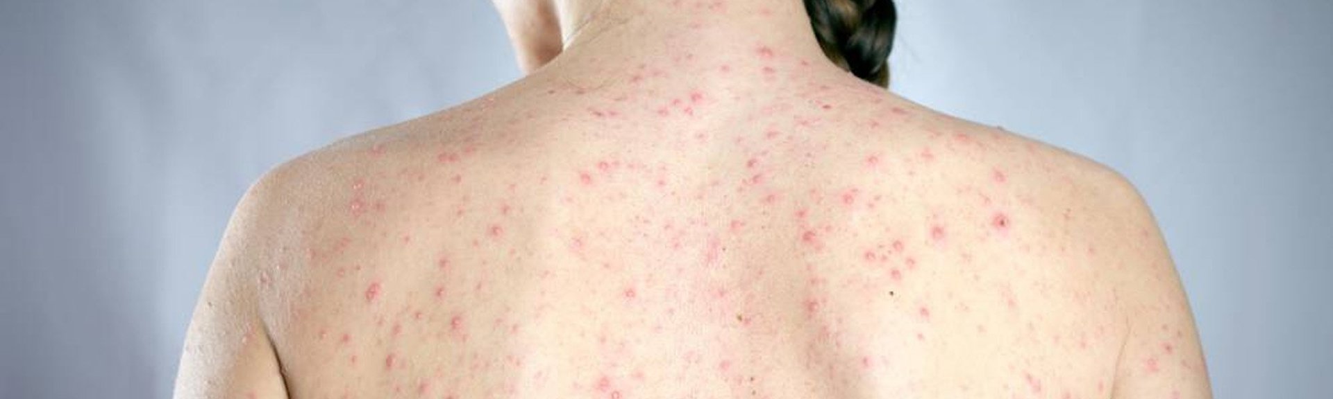 Jeuk op mijn rug: wat kan ik doen?|La Roche-Posay - La Roche Posay