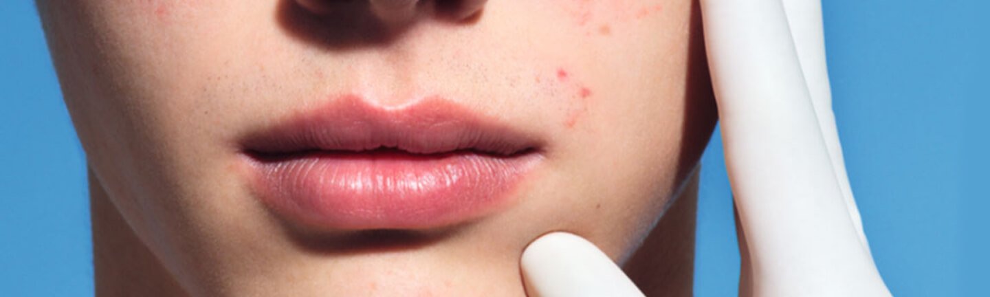 Acne bij jongeren: oplossingen en verzorging | La Roche-Posay