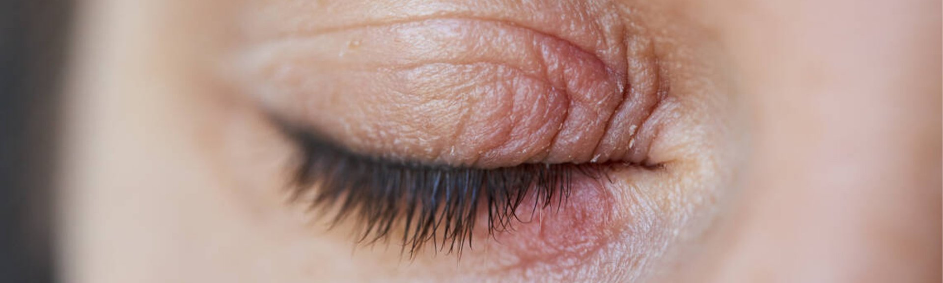 Eczéma des paupières : Reconnaître et Soulager | La Roche Posay