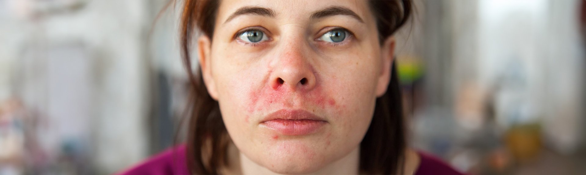 Eczeem gezicht en hals bestrijden | La Roche-Posay