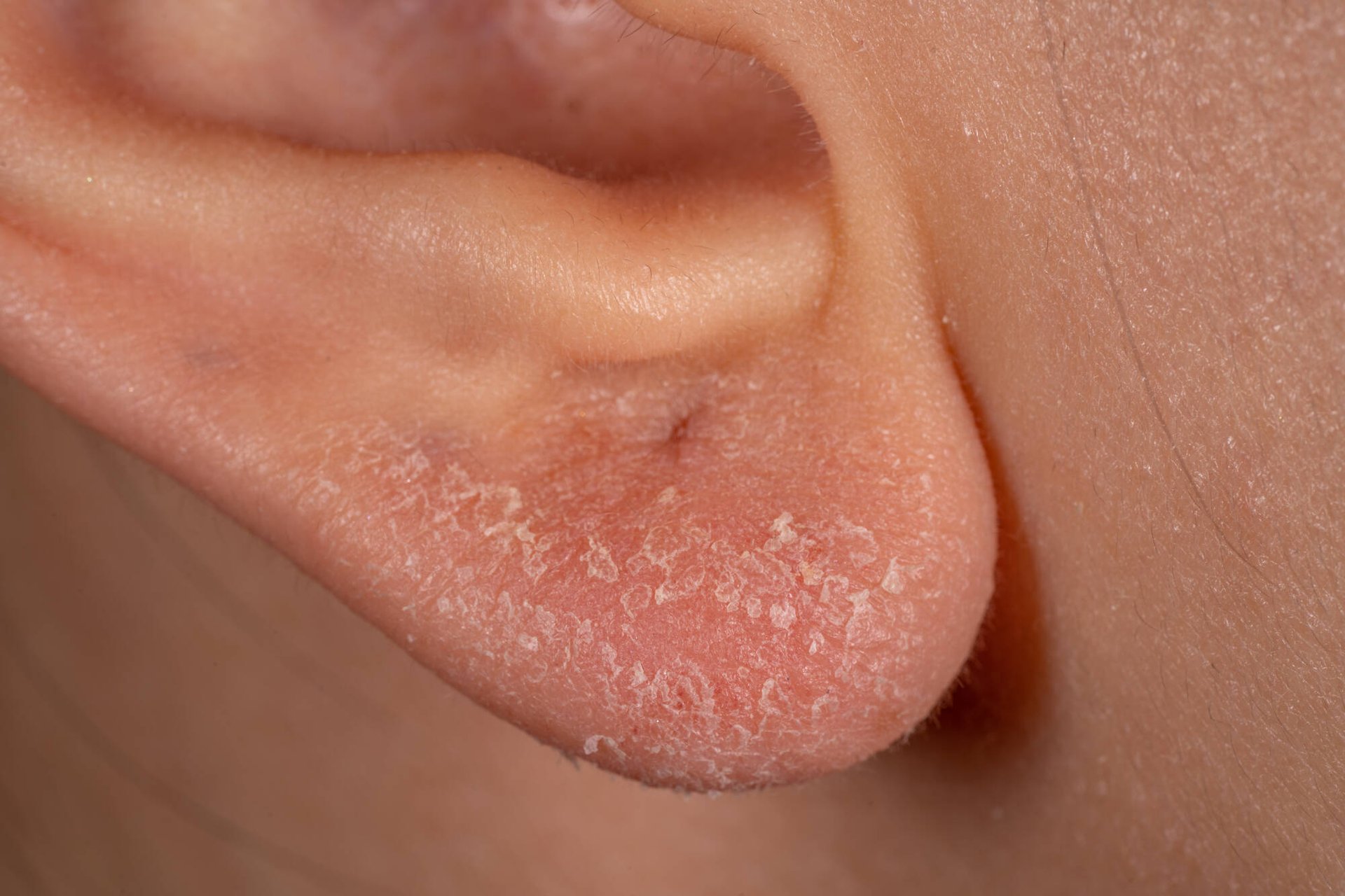 Eczeem in het oor: oorzaken en behandeling | La Roche-Posay