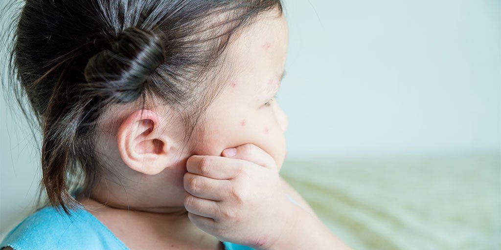 Jeuk op mijn rug: wat kan ik doen?|La Roche-Posay - La Roche Posay