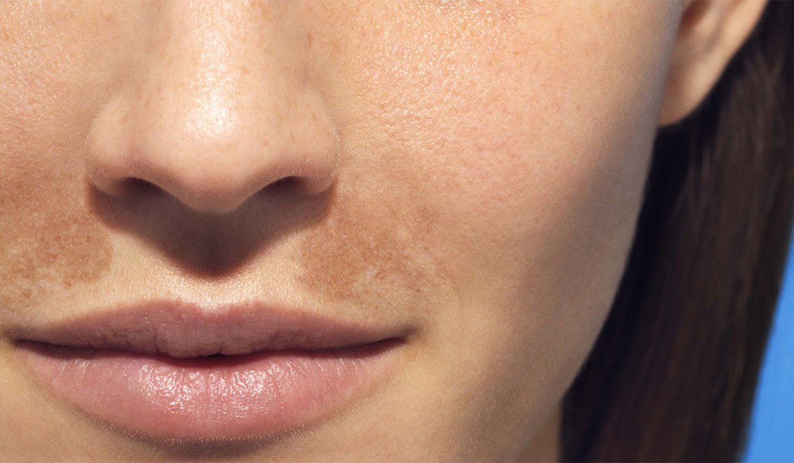 Les causes de l'hyperpigmentation et comment l'atténuer | La Roche-Posay