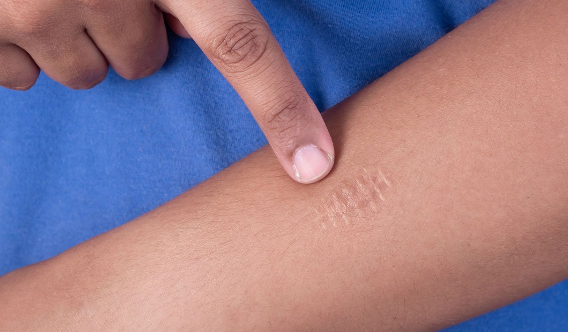 Cicatrices et points de suture : causes, produits de La Roche-Posay