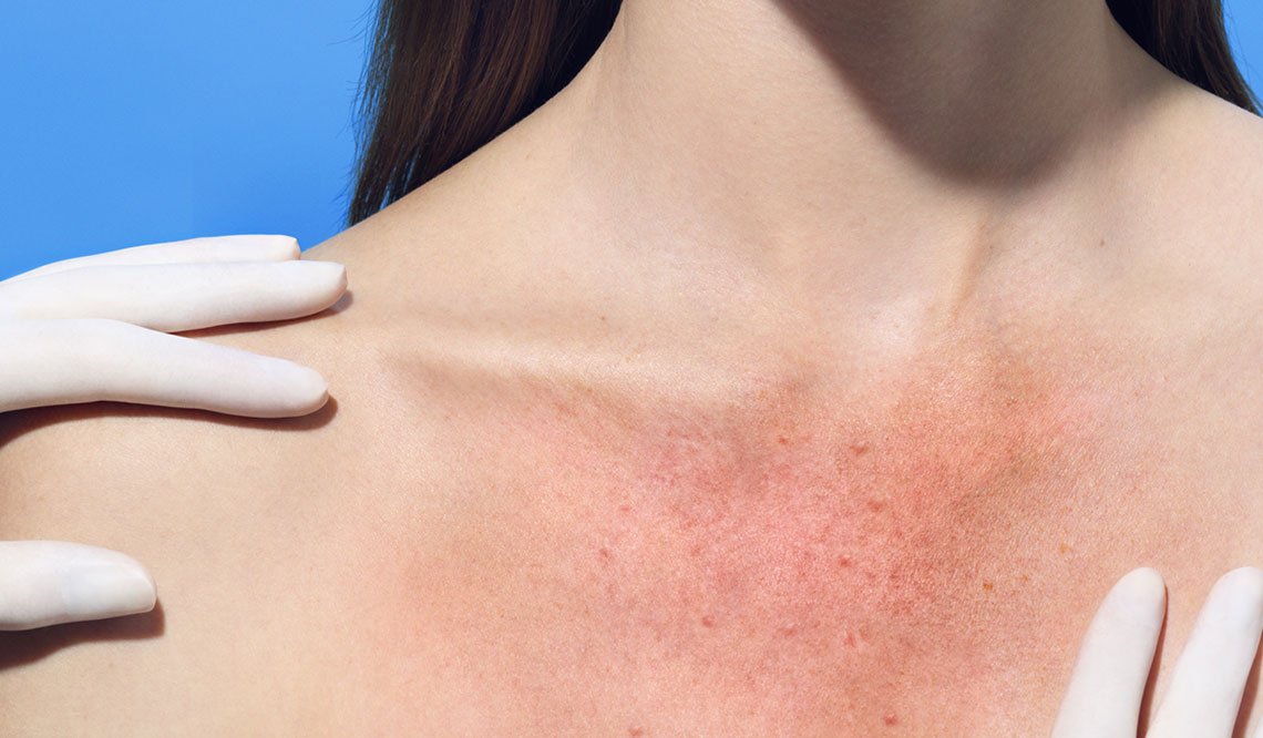 Solutions pour Allergie à la Crème Solaire | la Roche-Posay